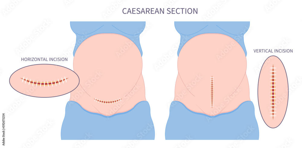 Tummy Scar Childbirth Delivery Caesarean C section newborn Baby birth ...