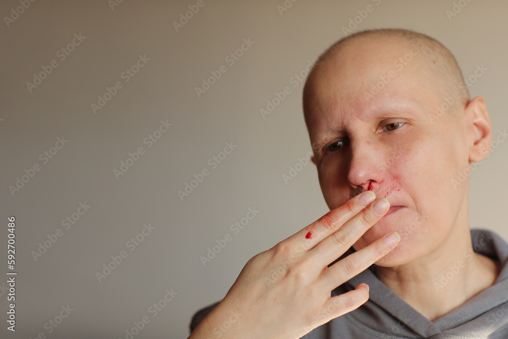 Hairless cancer sick female patient is bleeding from her nose, effects ...