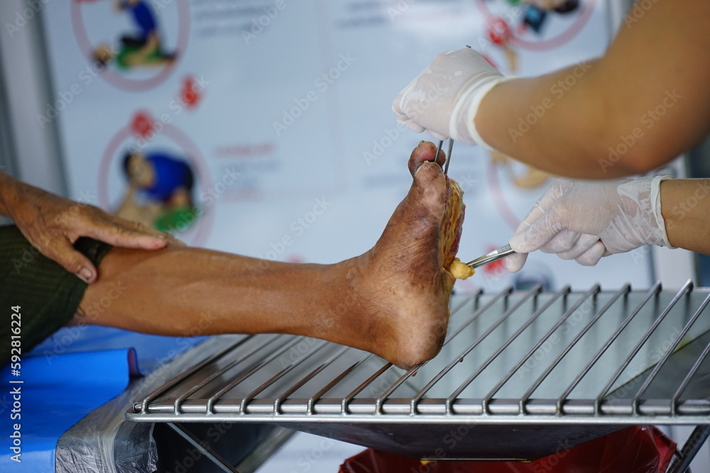 Washing wounds on the feet of diabetic patients. Stock Photo | Adobe Stock