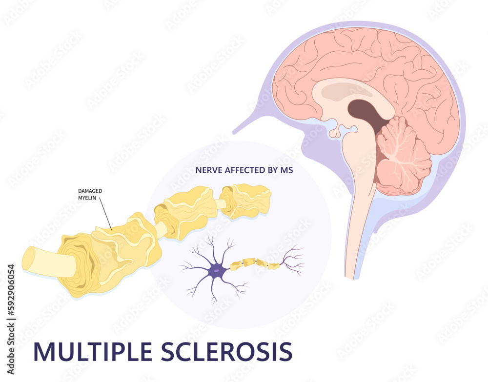 Multiple Sclerosis Amyotrophic lateral sclerosis myasthenia gravis ...