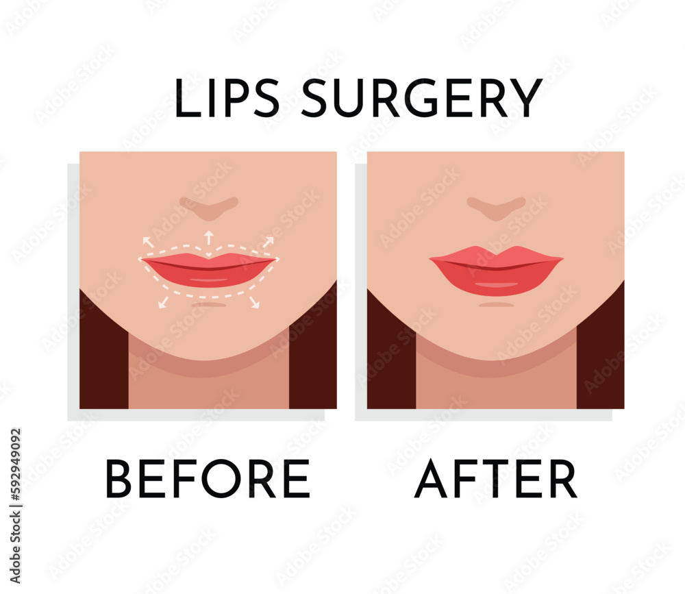 Lips Surgery correction Vector illustration. Plastic and aesthetic ...