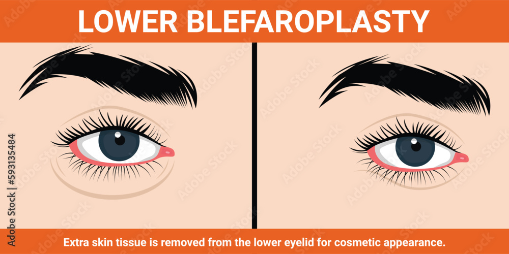Lower Blepharoplasty of eyelid, before and after vector illustration ...