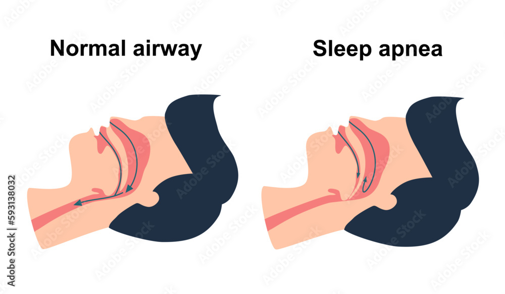 Obstructive sleep apnea syndrome concept vector illustration. Stock ...