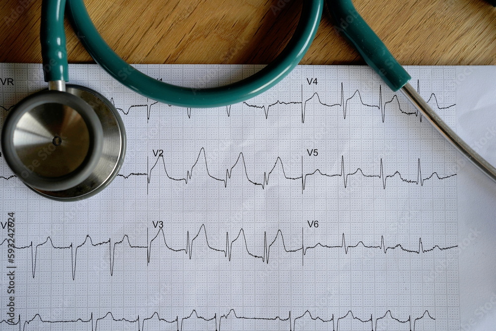 stethoscope on a real emergency ECG with a occlusive anterior ...