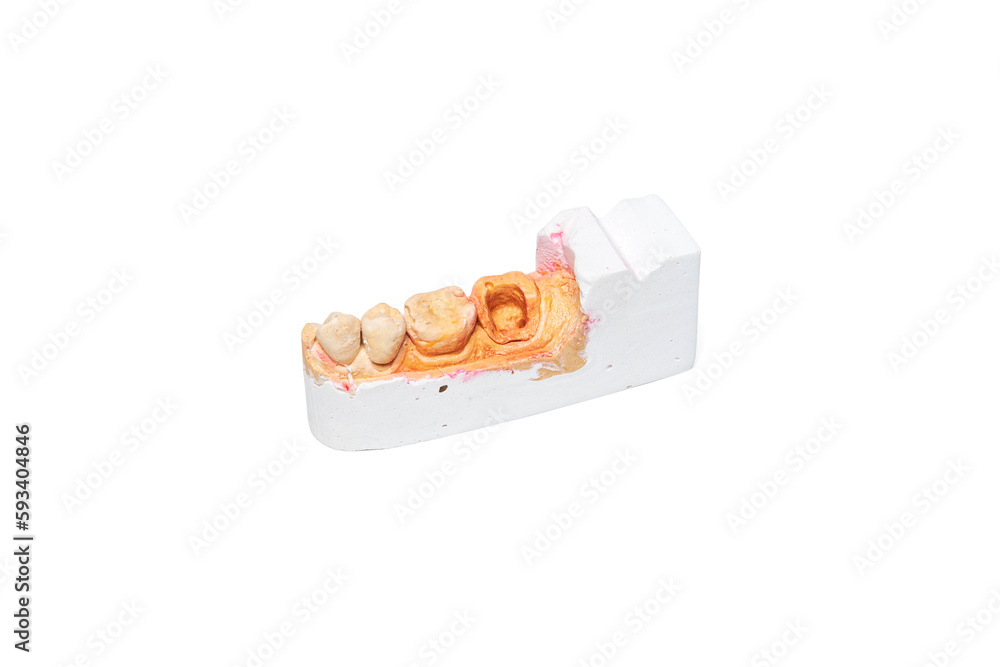 Plaster model of teeth. Dental prosthesis from gypsum model. Plaster ...