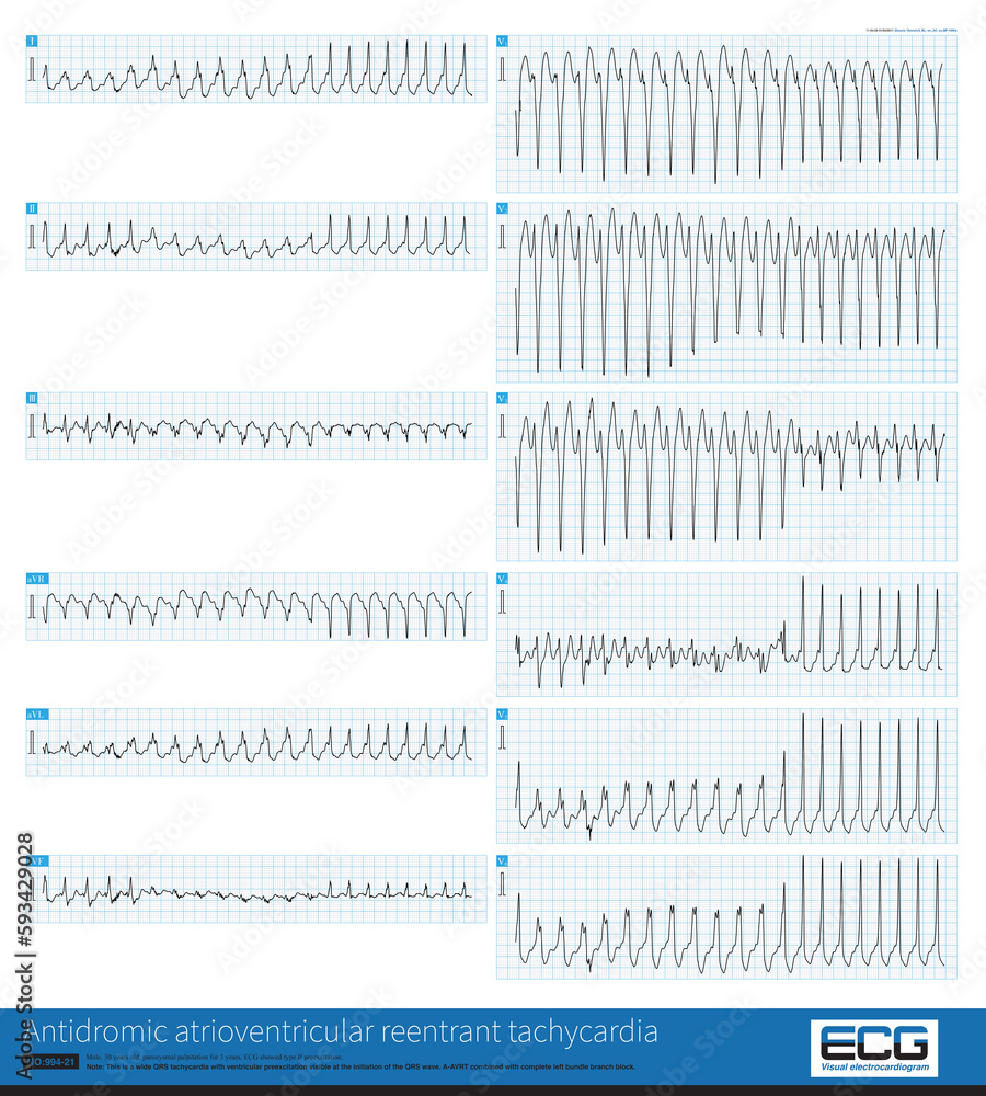 In one case of reentrant tachycardia involving the right accessory ...