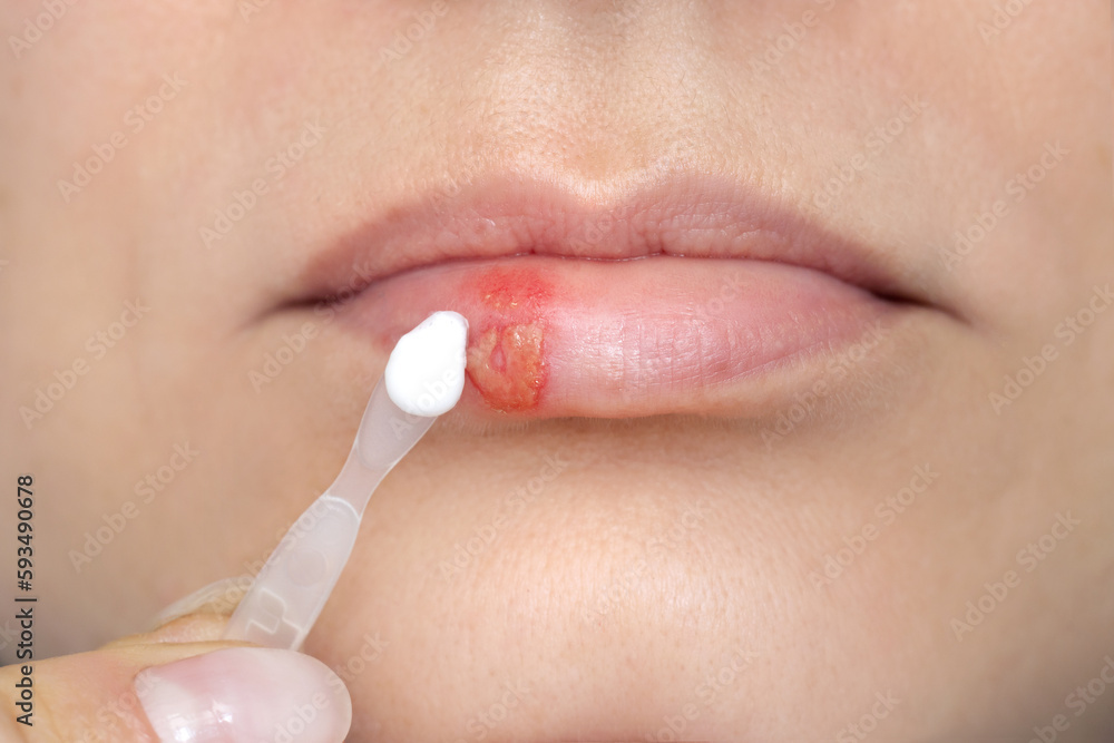Herpes on the lips of the young woman . Woman lubricates the labial ...