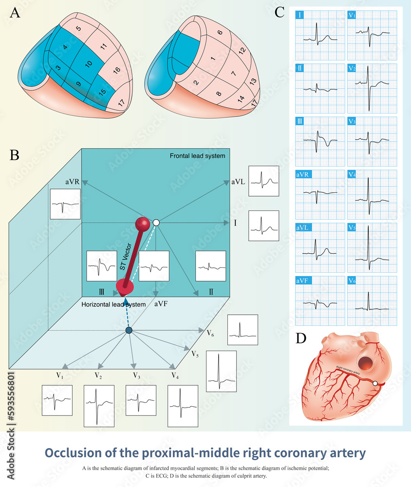 When the proximal to middle segment of the right coronary artery is ...