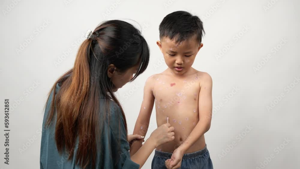 A mother is applying itching ointment to him 7 year old Asian boy ...