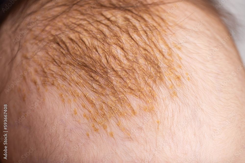 The process of formation of seborrheic dermatitis in an infant on the ...