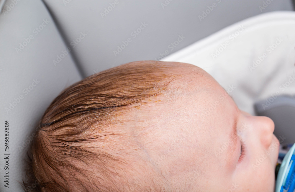 Smearing a seborrheic crust with baby oil on a child's head. Combing ...