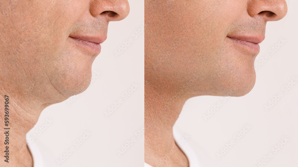 A close portrait of an aged man before and after the facial ...