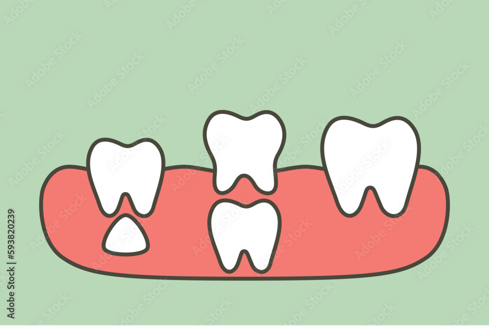 teeth are growing up from the gum by permanent tooth located below ...