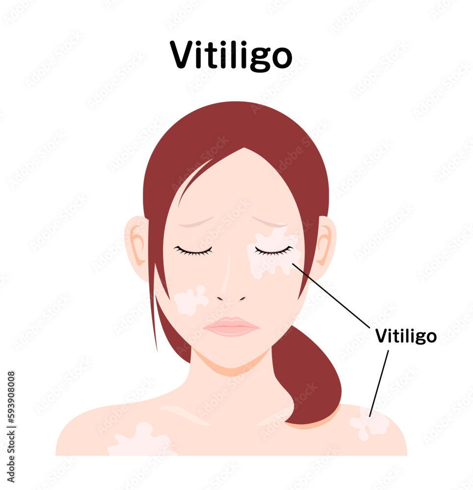 Symptoms of Vitiligo vector illustration Stock Vector | Adobe Stock