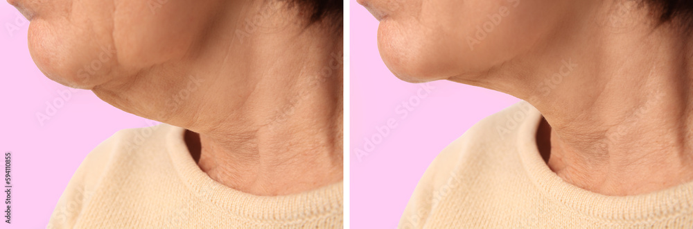 Double chin problem. Collage with photos of mature woman before and ...