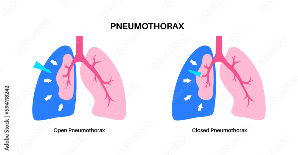 Vetor de Pneumothorax anatomical poster do Stock | Adobe Stock