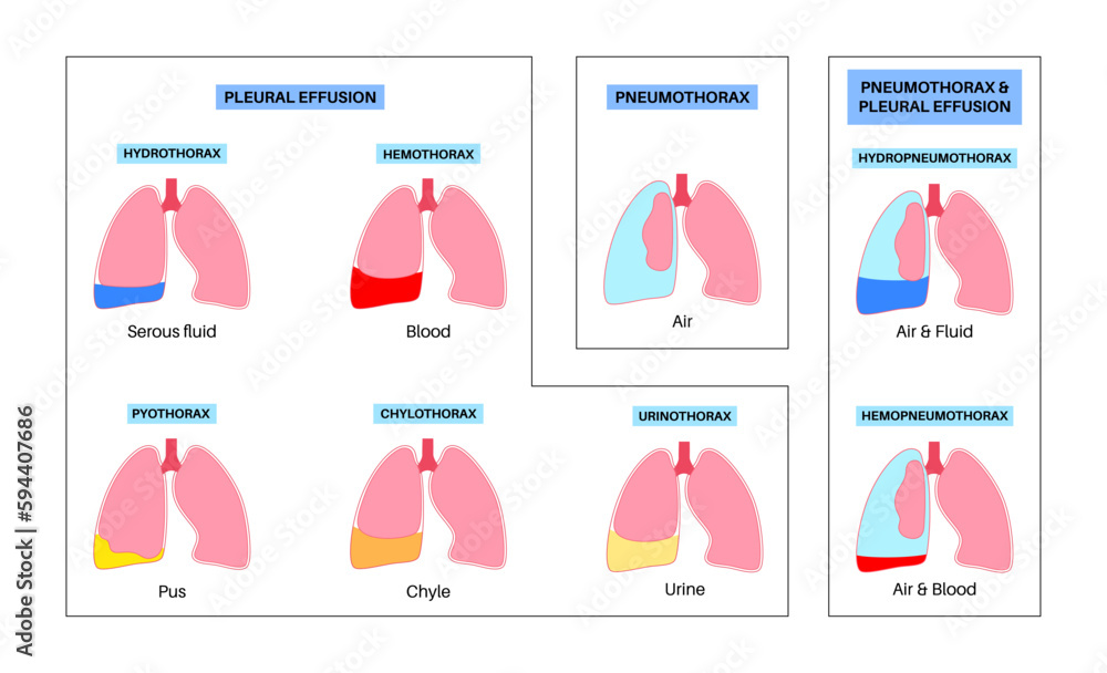 Pleural effusion poster Stock Vector | Adobe Stock
