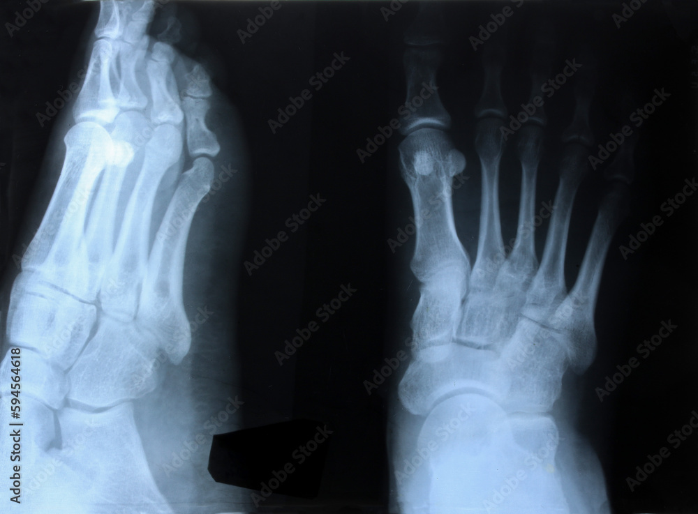 Close-up x-ray of the foot. condition of bones, joints and soft tissues ...