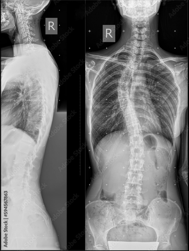 Panoramic x-ray of the spine in two projections. Single-arc right-sided ...