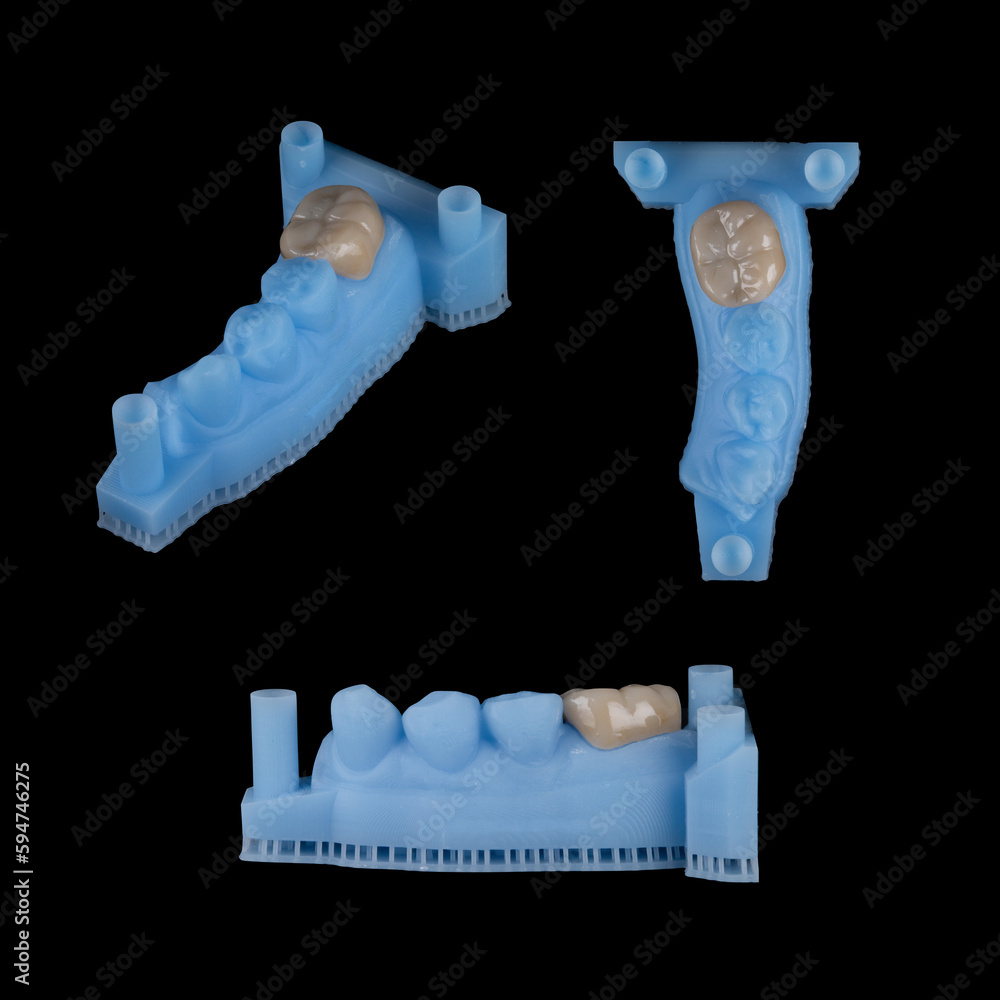 Printed model resin of dental mandibular arch with all ceramic zirconia ...