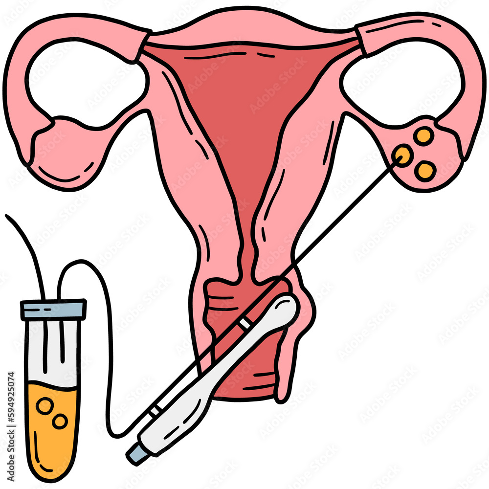 Egg retrieval and transvaginal oocyte extraction from ovaries, In Vitro ...