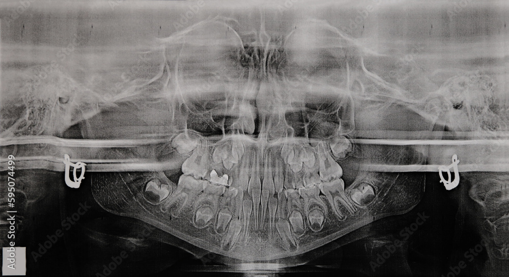X-ray scan:8 year old child with unerupted permanent teeth Stock Photo ...