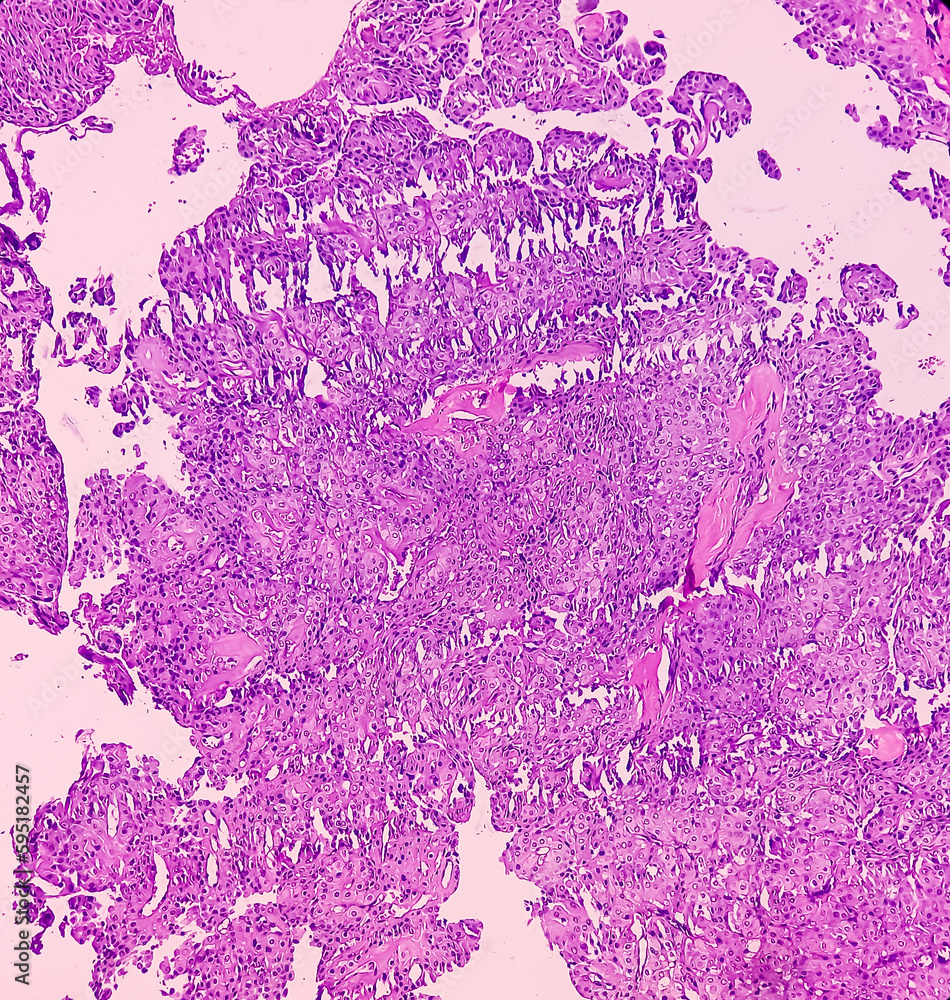 Foto de Nodular cystic Hidradenoma. Clear cell hidradenoma, nodular ...