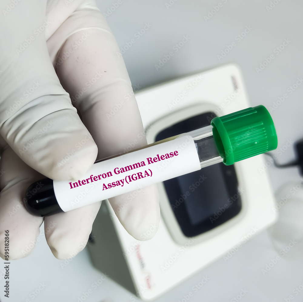 Blood sample for Interferon Gamma Release Assay (IGRA) test for ...
