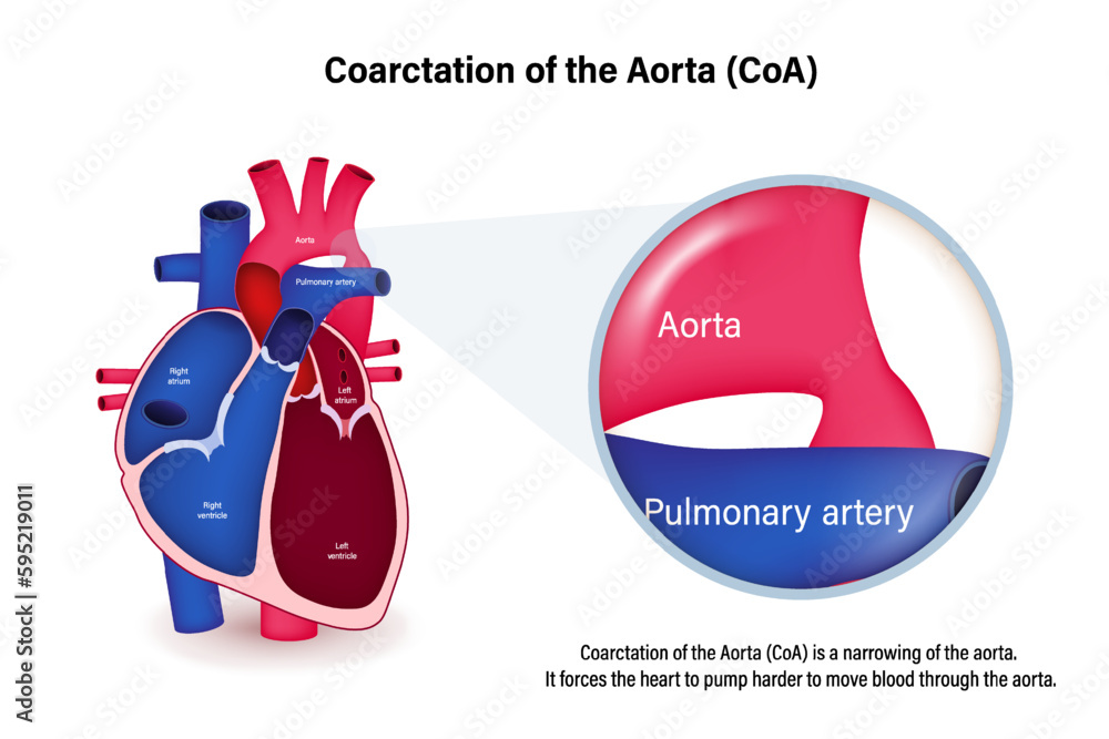 Poster Coarctation of the Aorta vector. Congenital heart disease ...