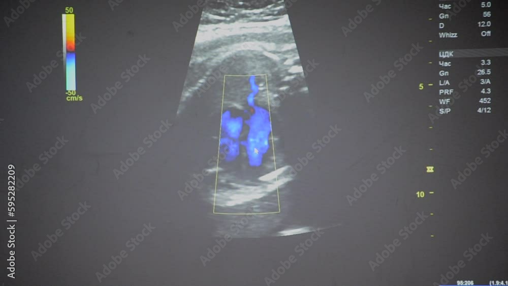 Vidéo Stock Ultrasound on monitor. Ultrasound image on computer monitor ...