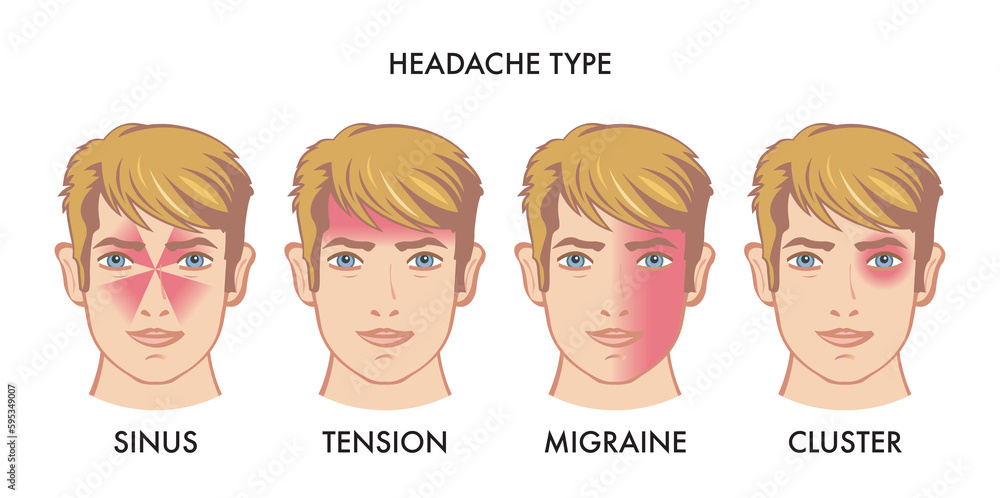 Illustration of types of headache Stock Illustration | Adobe Stock