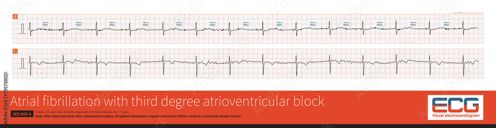 Cardiac surgery is one of the common causes of iatrogenic ...