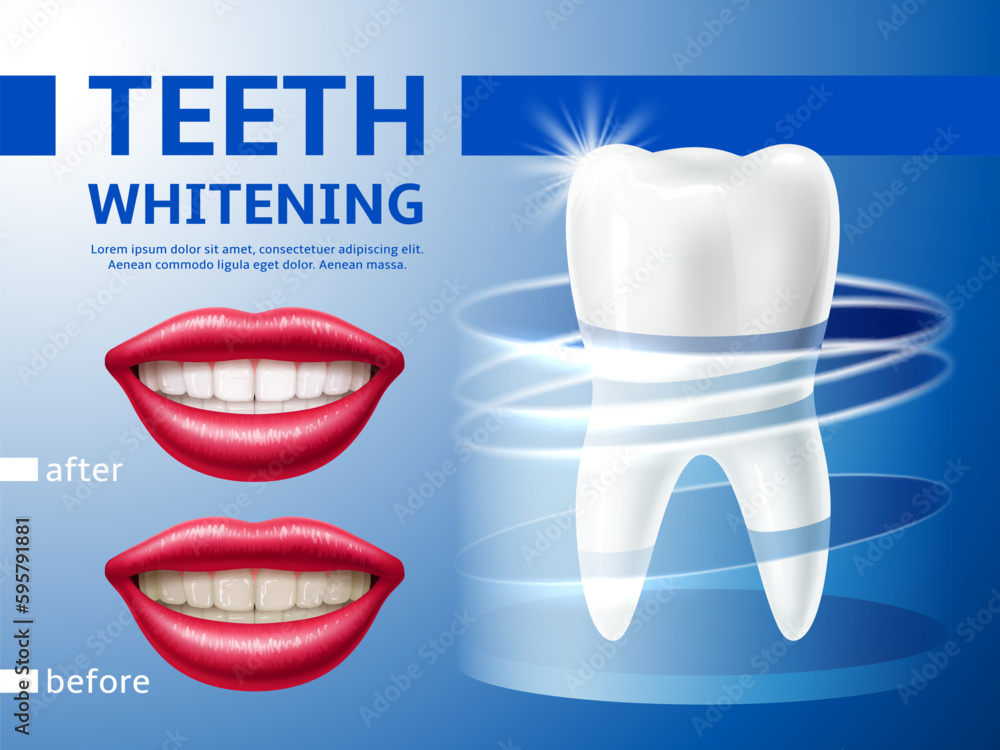 Teeth whitening poster. Realistic 3d smiling lips with perfect result ...