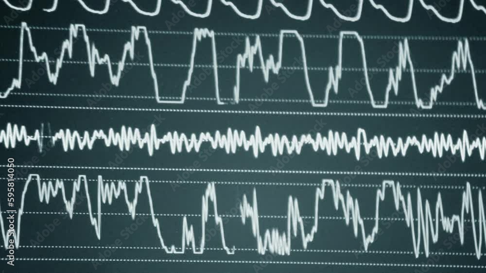 Modern patient monitor. Electronic Health Monitor displaying medical ...