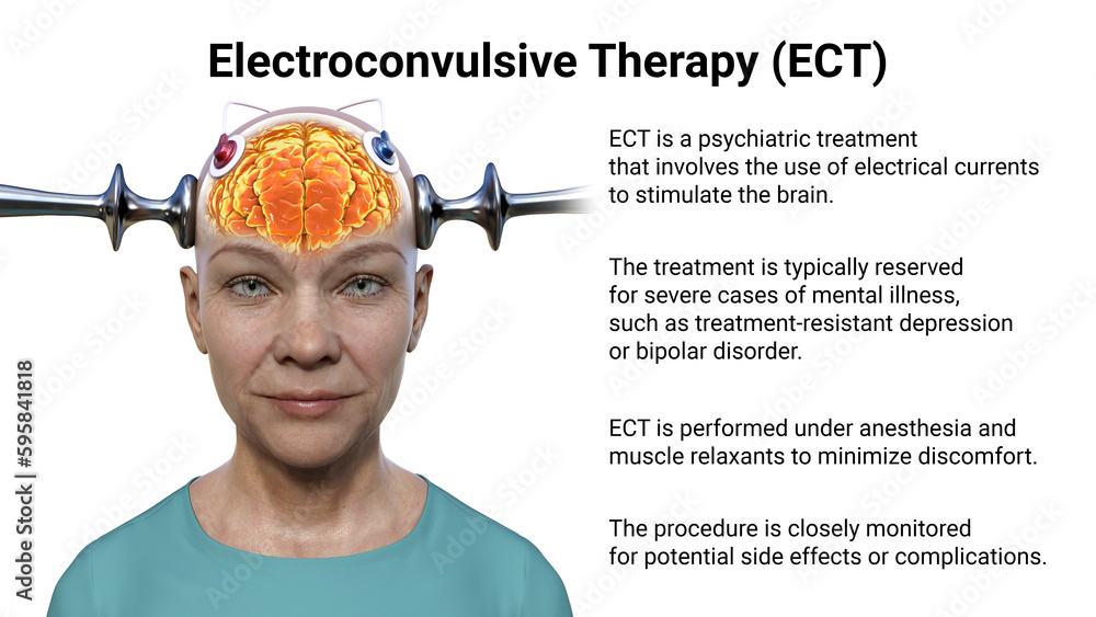Electroconvulsive therapy, ECT, a treatment involving the use of ...