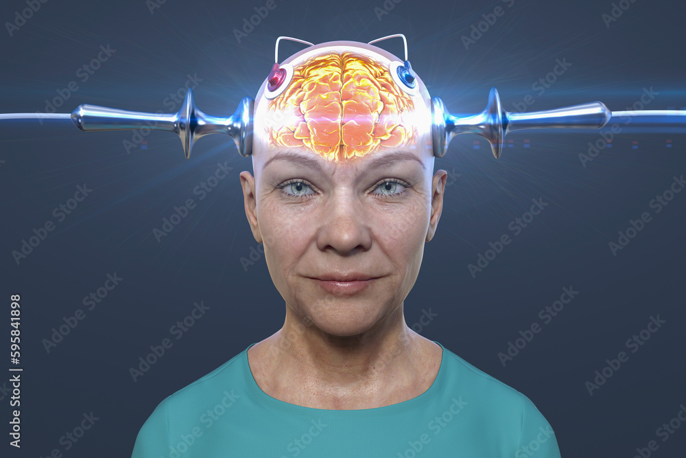 Electroconvulsive therapy, ECT, a treatment involving the use of ...
