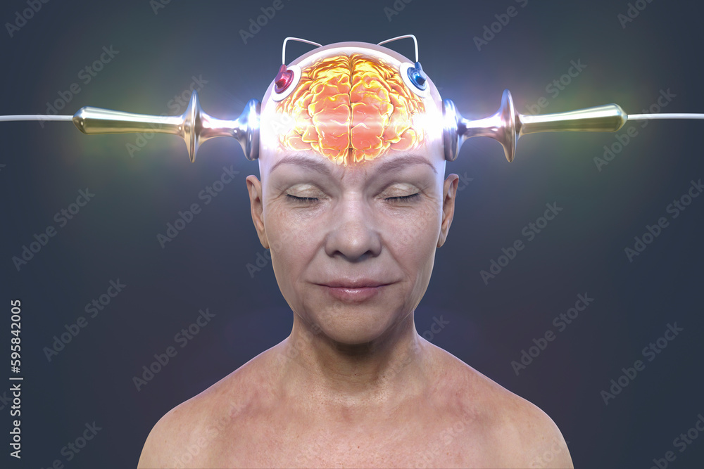 Electroconvulsive therapy, ECT, a treatment involving the use of ...