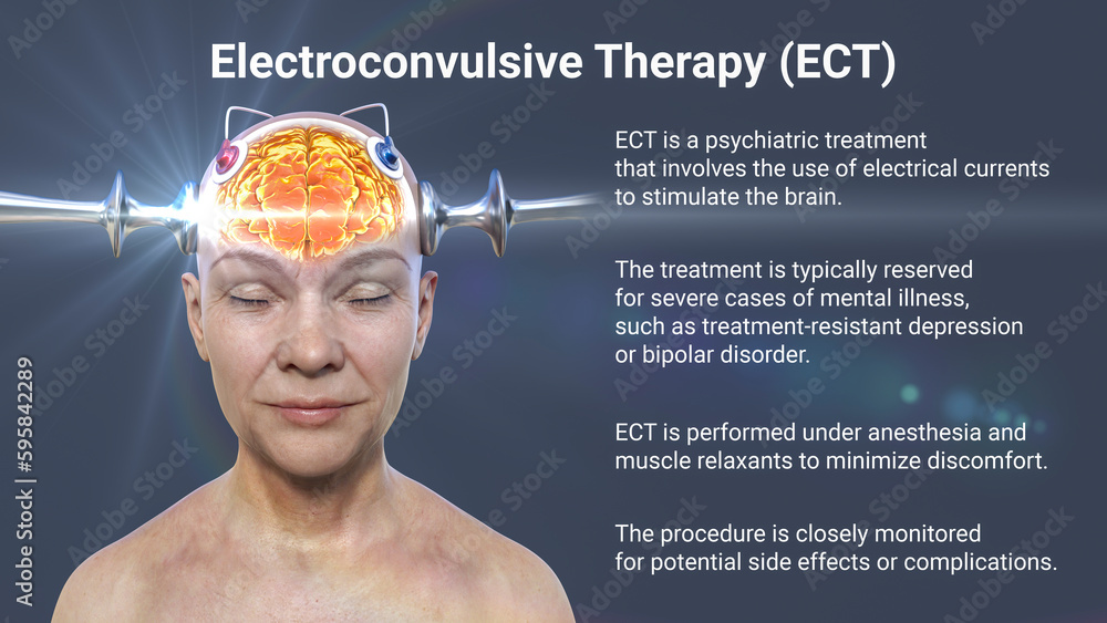 Electroconvulsive therapy, ECT, a treatment involving the use of ...