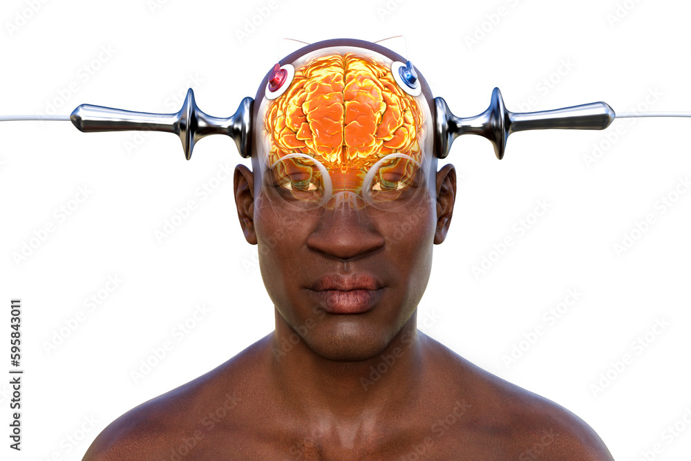 Electroconvulsive therapy, ECT, a treatment involving the use of ...