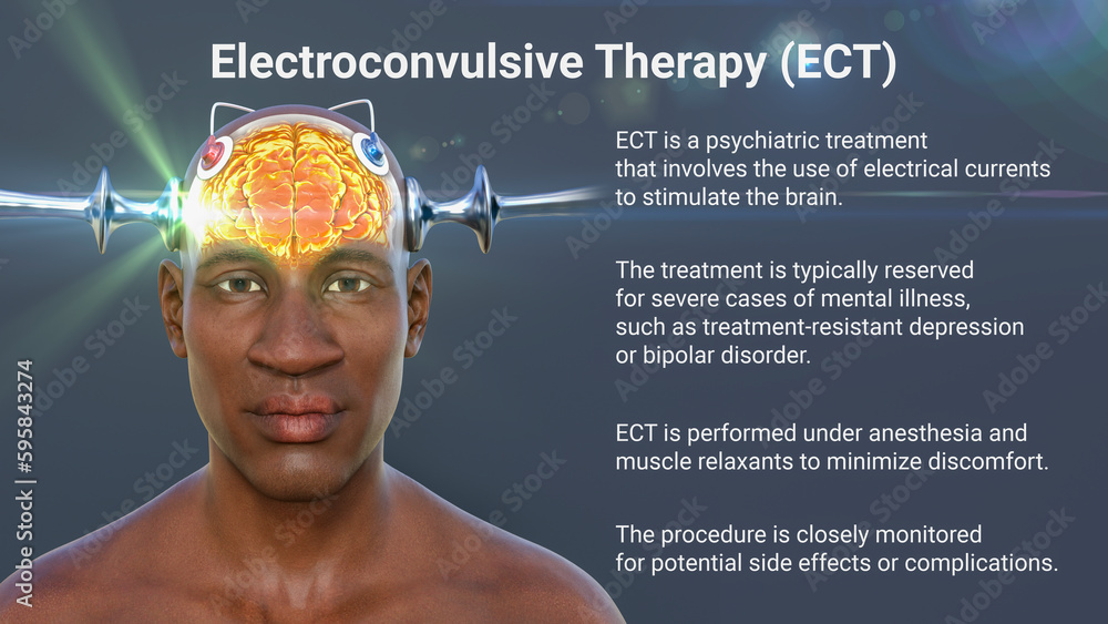 Electroconvulsive therapy, ECT, a treatment involving the use of ...