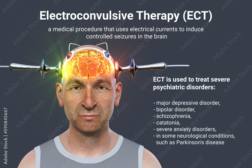 Electroconvulsive therapy, ECT, a treatment involving the use of ...