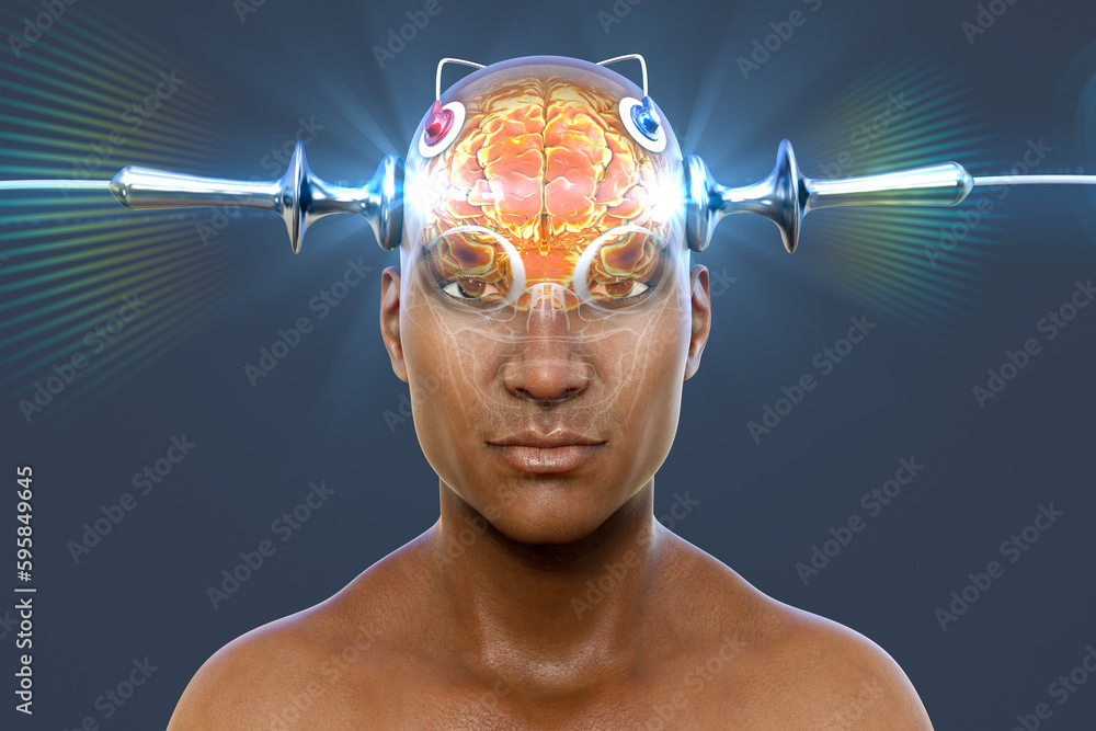 Electroconvulsive therapy, ECT, a treatment involving the use of ...