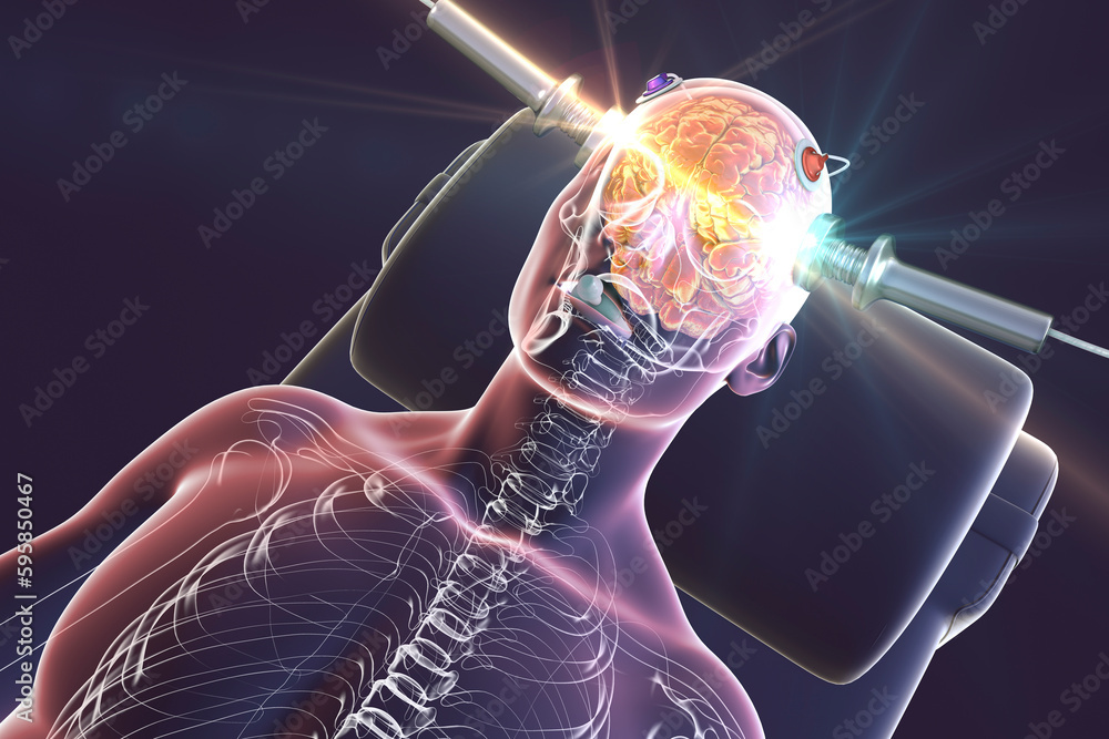 Electroconvulsive therapy, ECT, a treatment involving the use of ...