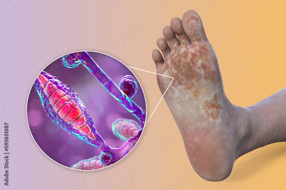 The Foot With Mycosis And Close Up View Of Fungi Microsporum Canis 3d