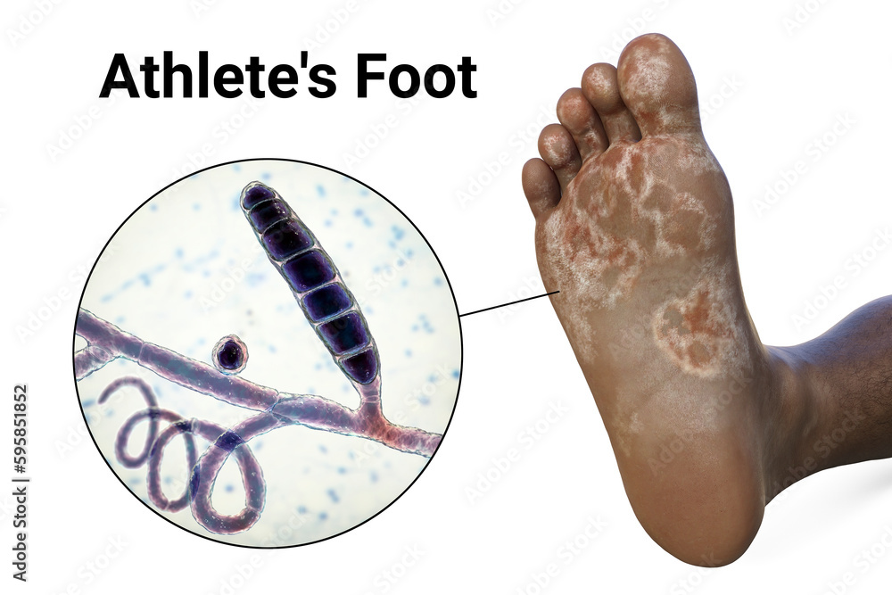 The foot with mycosis, and close-up view of fungi that cause Athlete's ...
