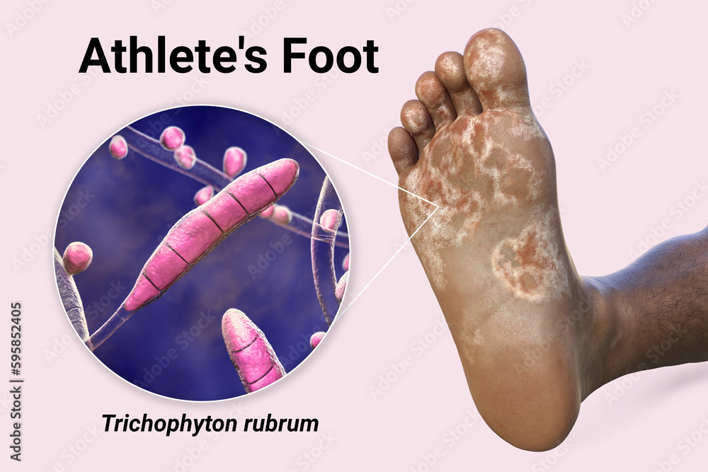 The foot with mycosis, and close-up view of fungi that cause Athlete's ...