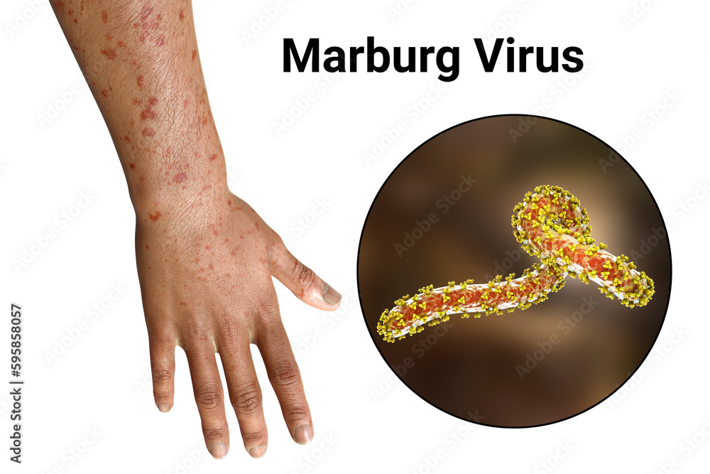Poster A skin rash on the arm of a patient with Marburg hemorrhagic fever and close-up – Tableau ...