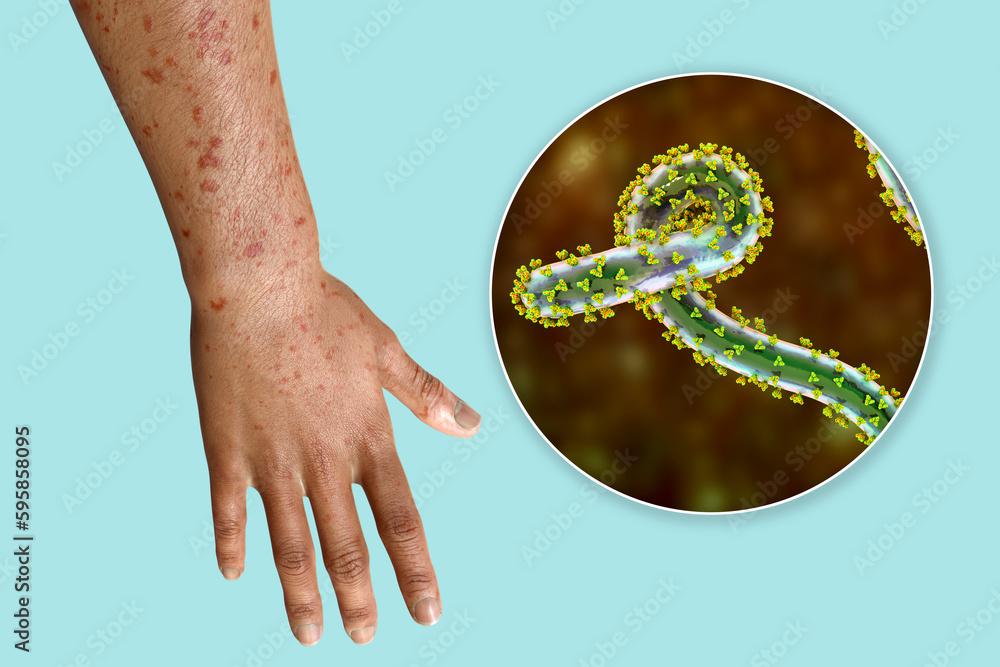 A skin rash on the arm of a patient with Marburg hemorrhagic fever and close-up view of the ...