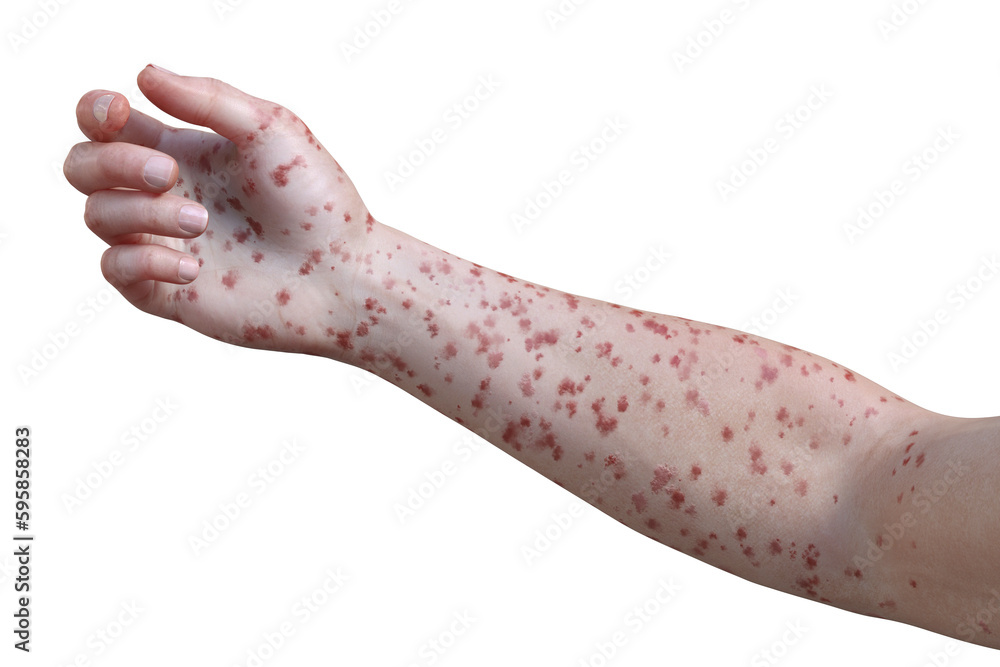 A skin rash on the arm of a patient with Marburg hemorrhagic fever, 3D ...