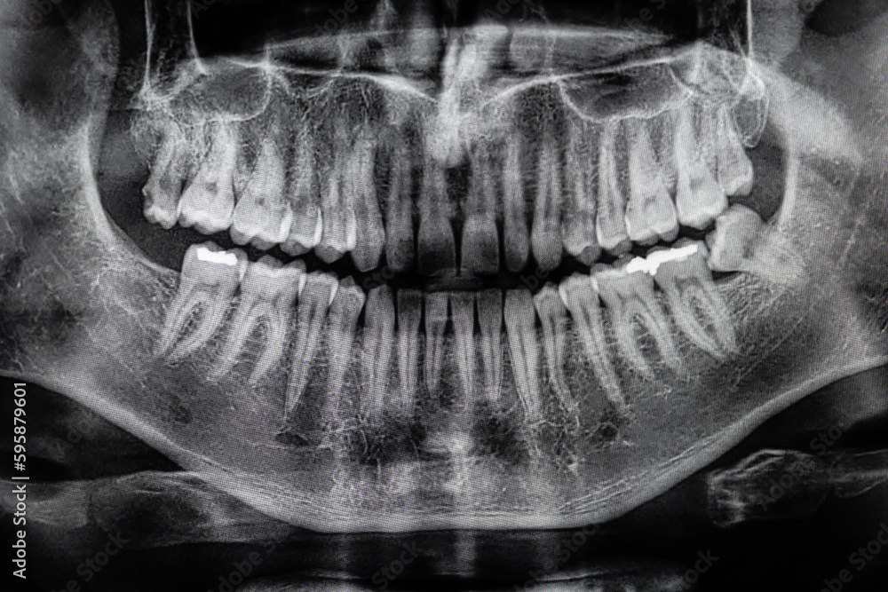 Orthopantomography, OPG X-ray DR digital wisdom teeth. panoramic film x ...